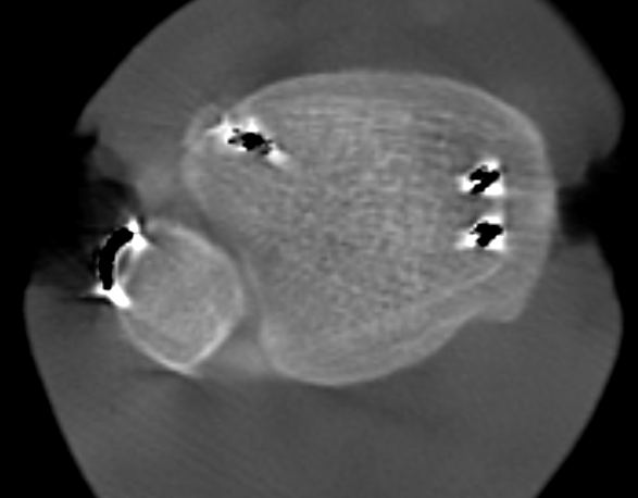 Chaput tubercle syndesmosis avulsion Weber C bilmalleolar ankle fracture