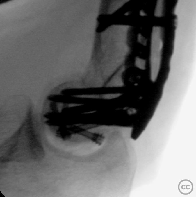 Dubberly 3/4 shear plus comminuted trans condylar trochlear fracture ...