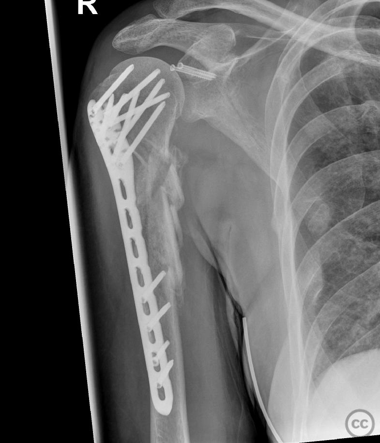 Multifragmentary Proximal Humerus Fracture with Scapula Fracture in a ...