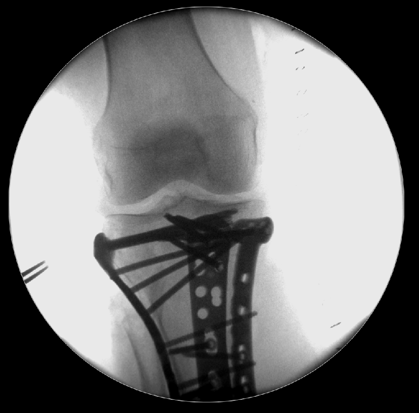 Schatzker VI tri-condylar fracture with pseudo PLC disruption
