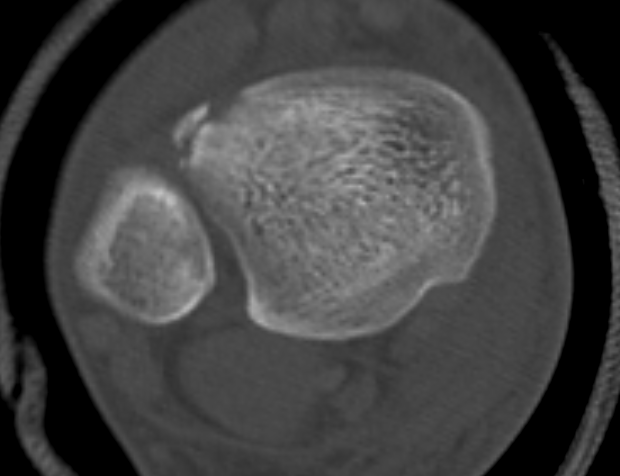 Chaput tubercle syndesmosis avulsion Weber C bilmalleolar ankle fracture