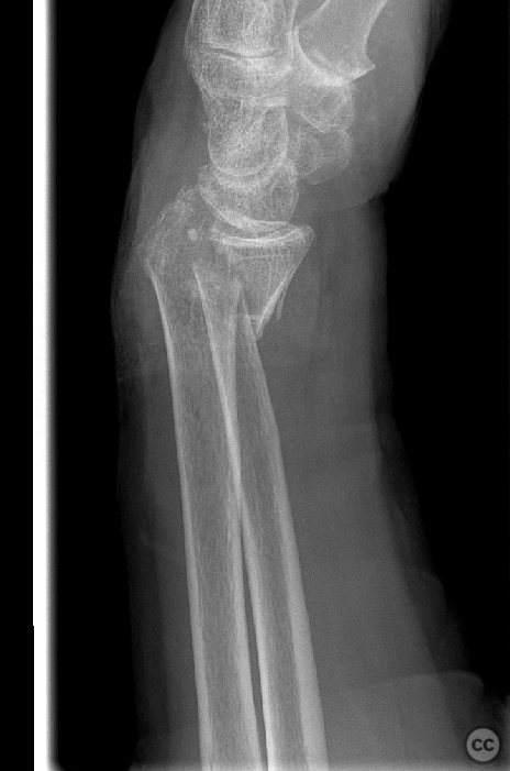 Radiocarpal distraction reduction technique for distal radius fracture