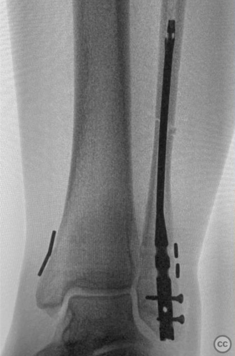Functional Bimalleolar Ankle Fracture with Syndesmotic Injury and ...