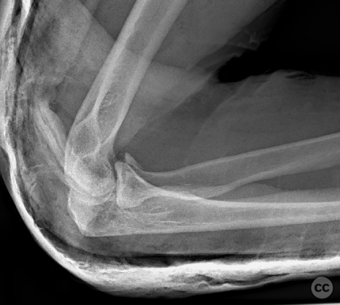 PMRI following elbow dislocation with pMCL insufficiency