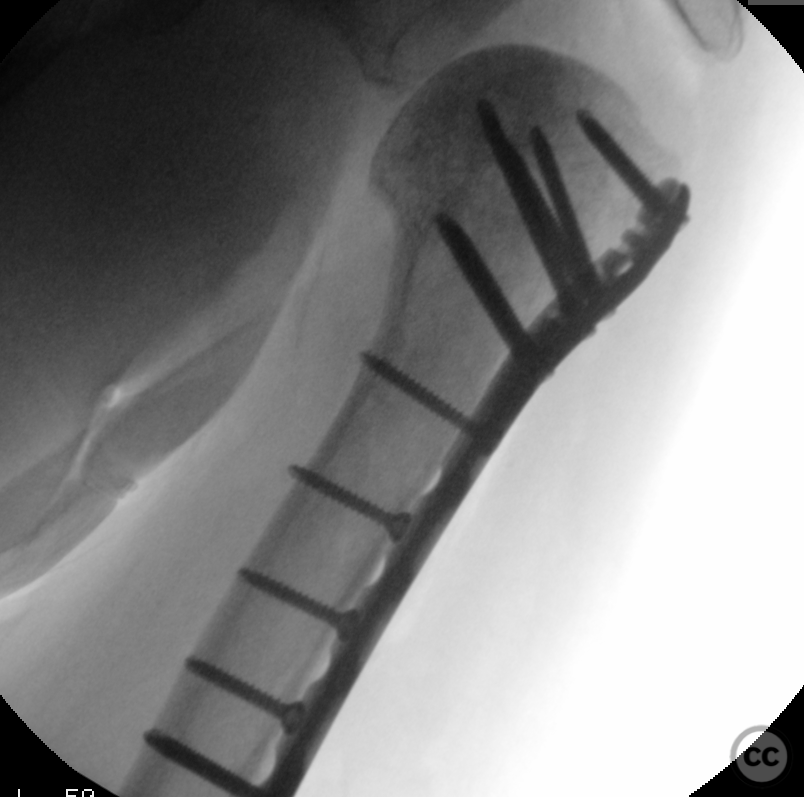 Prox 1/3 humeral shaft fracture with concomitant GH osteoarthritis