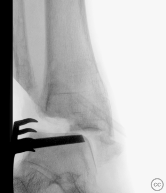 Failed pronation - external rotation (PER) ankle fracture dislocation