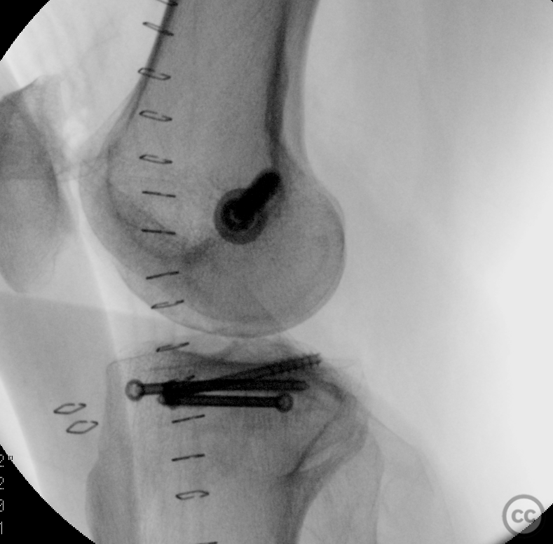 Lateral femoral epocondyle osteotomy and jail-screw fixation of the ...