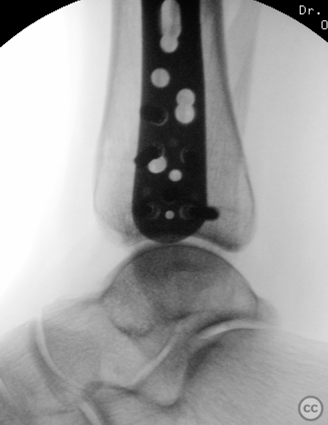 Combined distal 1/3 tibia fracture with SAD bimalleolar ankle fracture