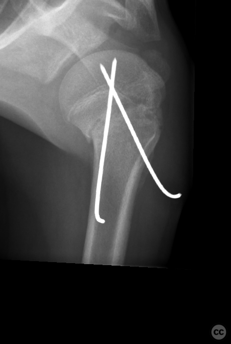 Salter 2 proximal humerus fracture kapandji technique