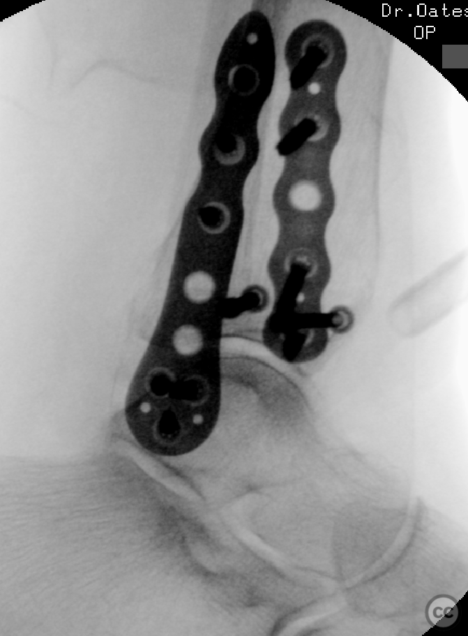 Bimalleolar Supination Adduction (SAd II) ankle injury