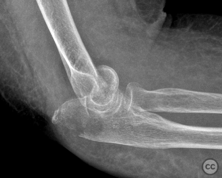 Transolecranon Dubberly 2B fracture dislocation