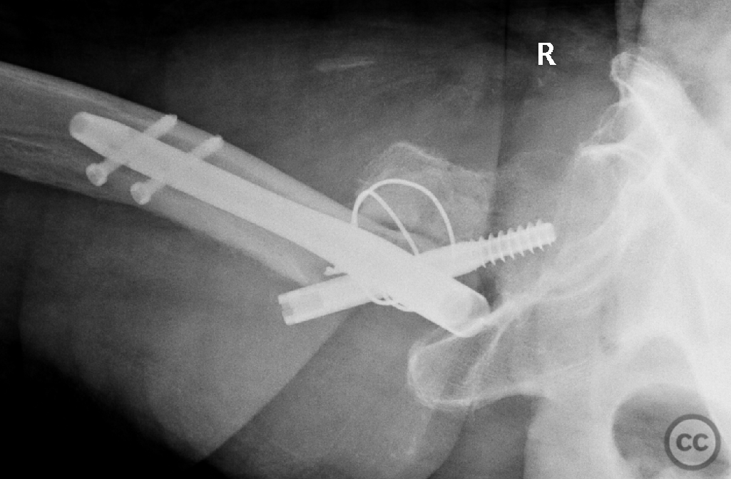 Failure of fixation - Gamma nail cut-out and arthroplasty revision