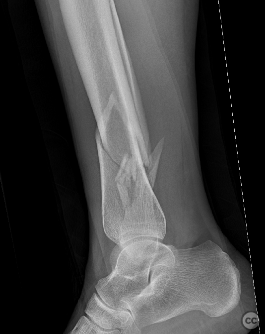 Combined distal 1/3 tibia fracture with SAD bimalleolar ankle fracture