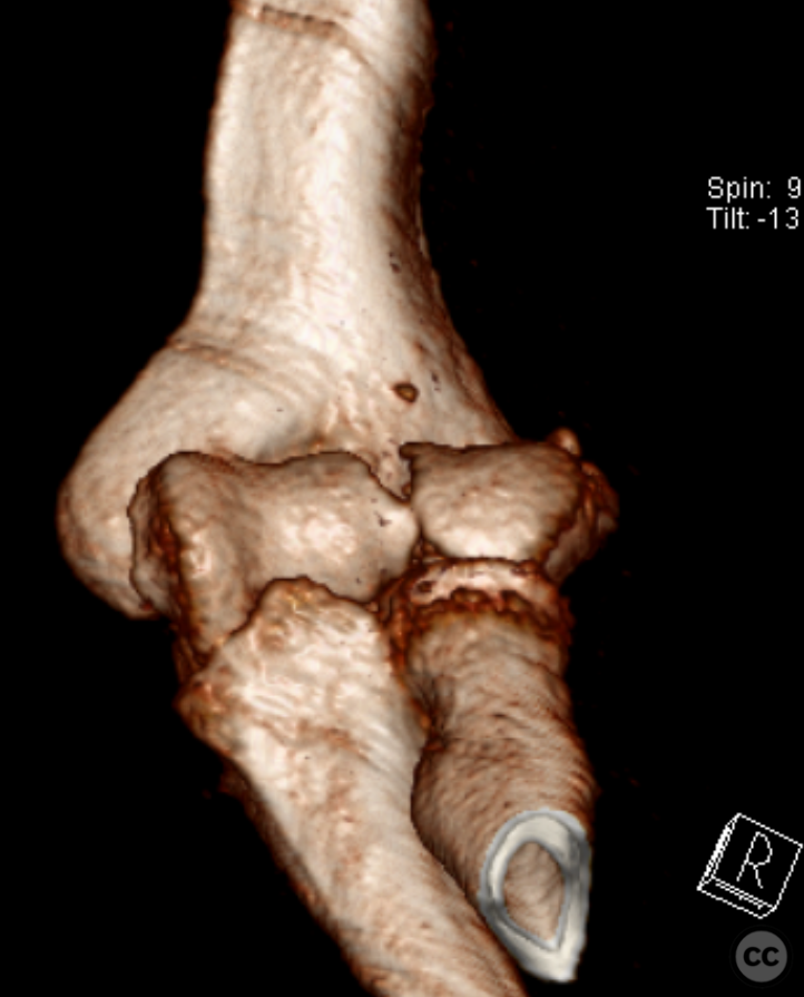 Dubberly 3/4 shear plus comminuted trans condylar trochlear fracture ...