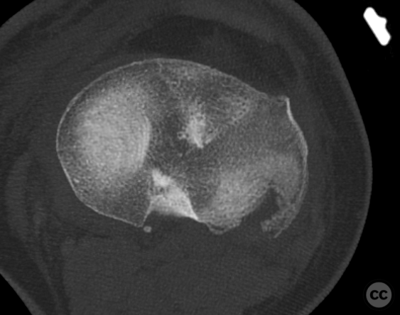 Lateral femoral epocondyle osteotomy and jail-screw fixation of the ...