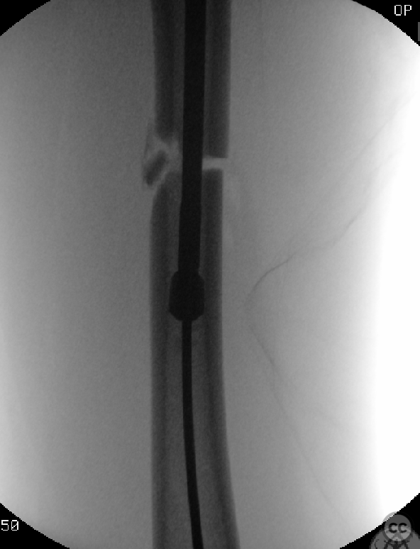 Simple transverse femoral shaft fracture