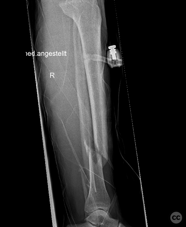 Distal 1/3 tibia shaft fracture with distal fibular fracture