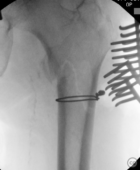 Classical intertrochanteric fracture with reverse oblique extension