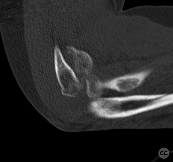 Fracture hemiarthroplasty distal humerus