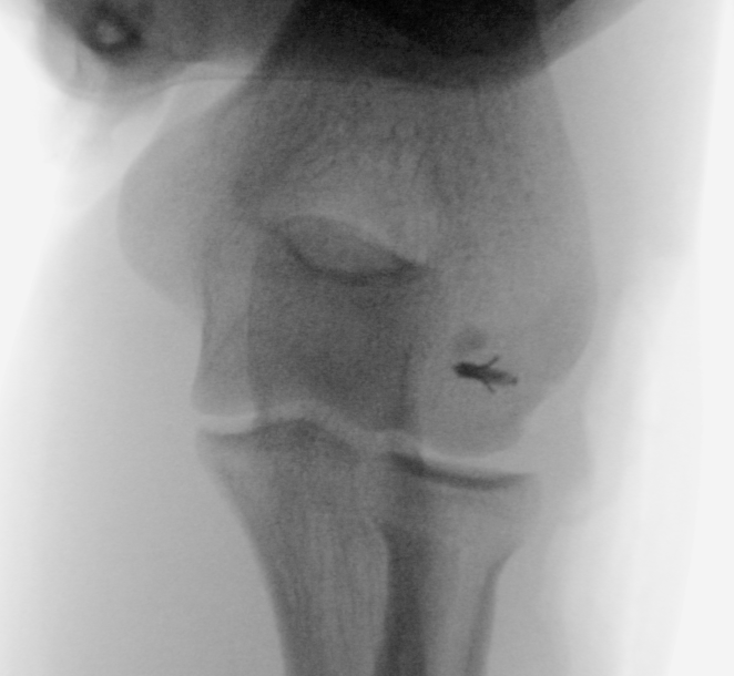 Multidirectional instability following posteromedial elbow dislocation