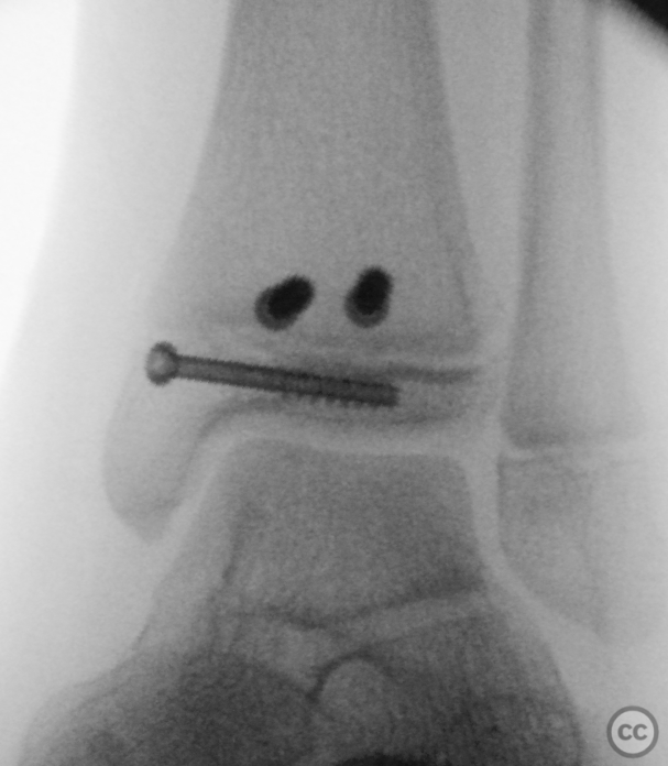 Percutaneous Cannulated Screw Fixation of a Triplanar Distal Tibial ...