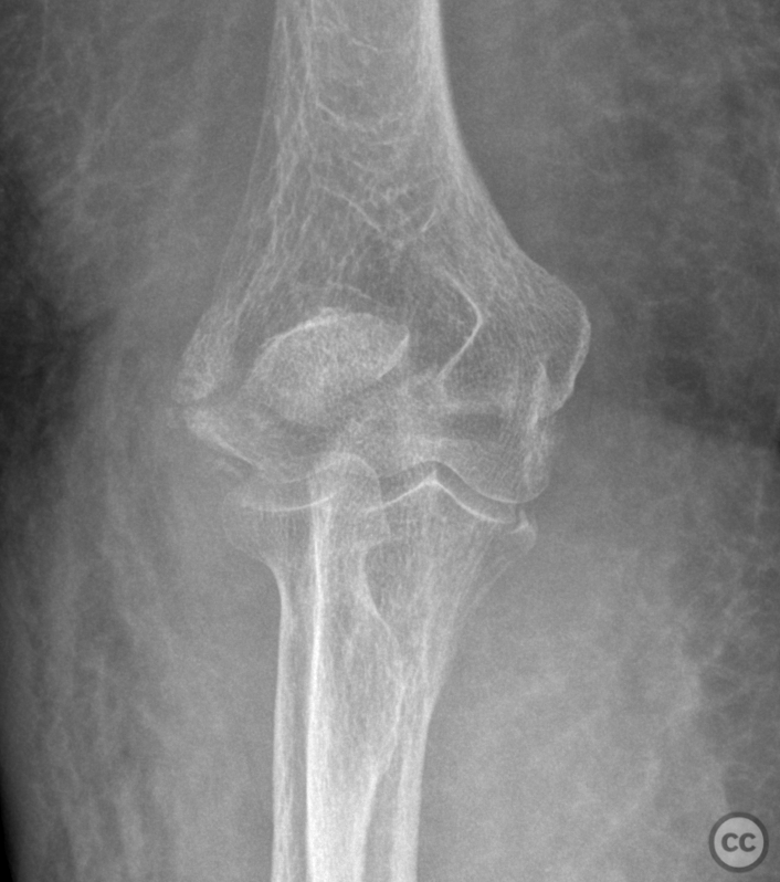 Transolecranon Dubberly 2B fracture dislocation