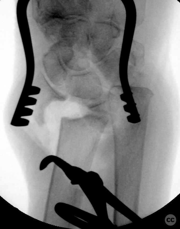 A modified E-FCR approach utilising a targeted radiocarpal ...