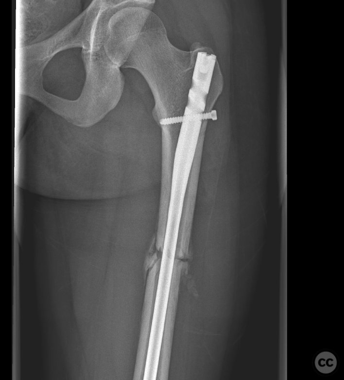 Simple transverse femoral shaft fracture