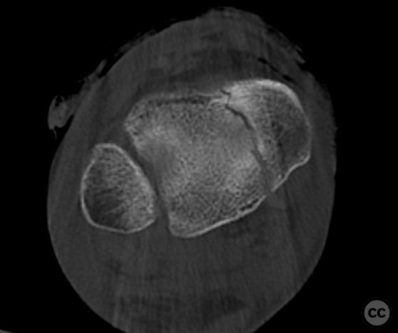 Combined distal 1/3 tibia fracture with SAD bimalleolar ankle fracture