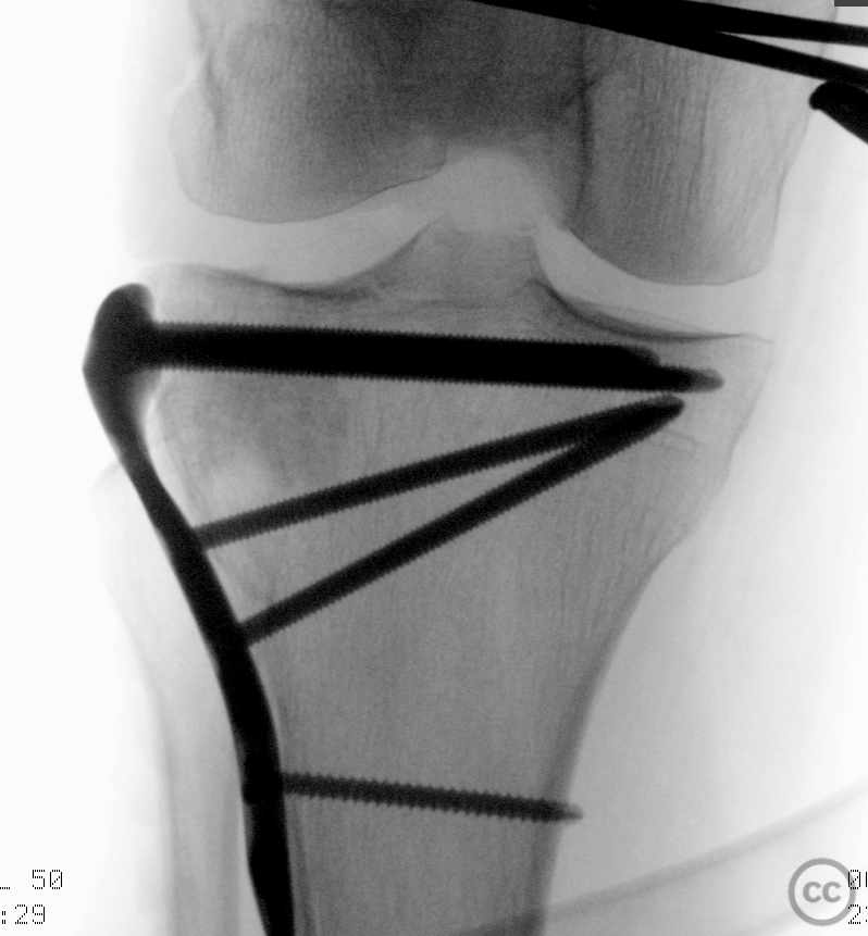 Shatzker 2 lateral tibial plateau fracture