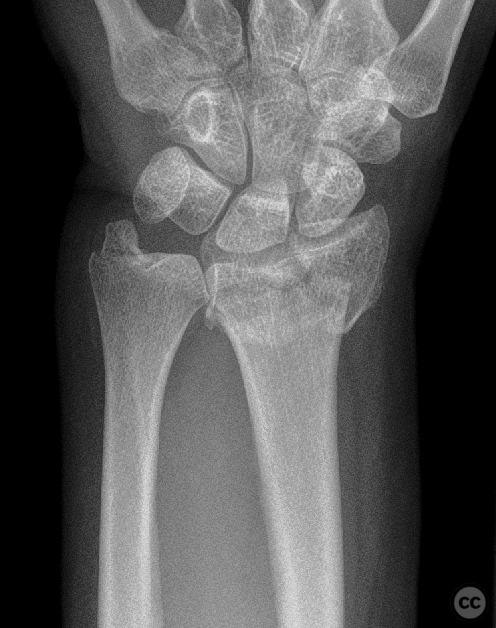 Reduction of the radial column preserving Brachioradialis using a ...