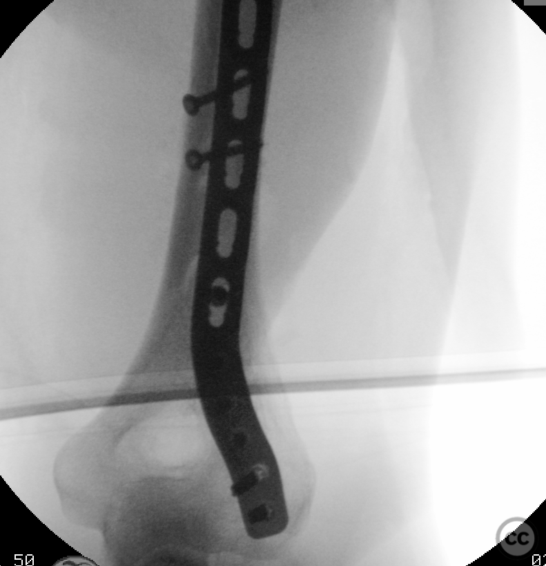 Distal 1/3 humerus shaft fracture - a lateral paratricipital approach ...