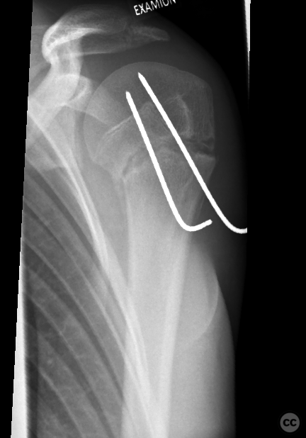 Salter 2 proximal humerus fracture kapandji technique