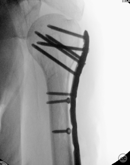 Anterolateral Helix plate - segmental proximal humerus fracture