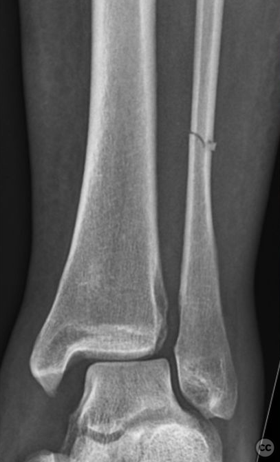 Functional Bimalleolar Ankle Fracture with Syndesmotic Injury and ...