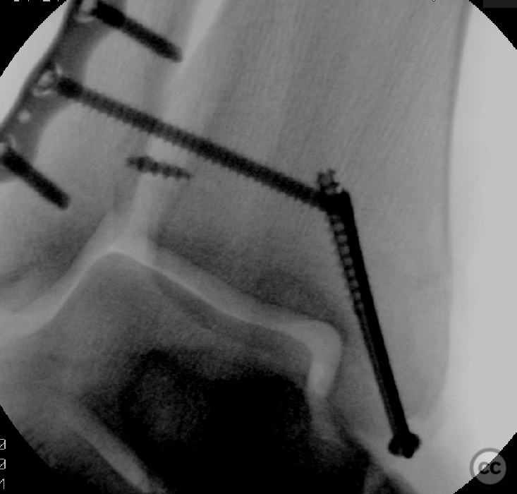Pronation Abduction (PAb) Weber C / Herscovici B bimalleolar ankle fracture