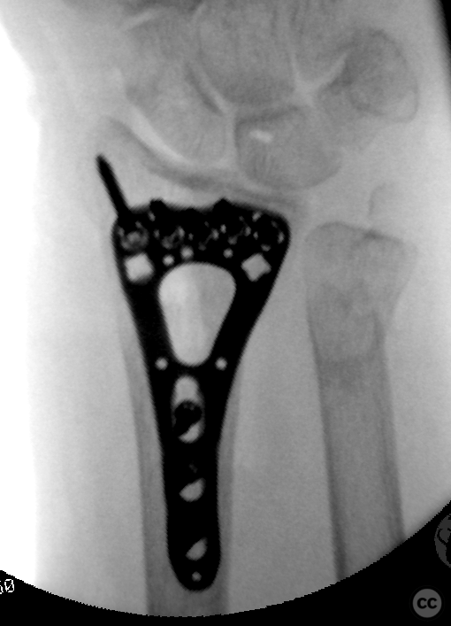 Radiocarpal distraction reduction technique for distal radius fracture