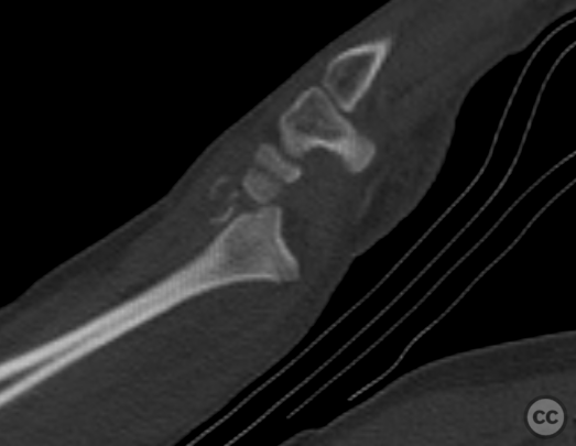 Malunion Salter III distal radius fracture dislocation