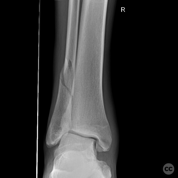 Pronation Abduction (PAb) Weber C / Herscovici B bimalleolar ankle fracture