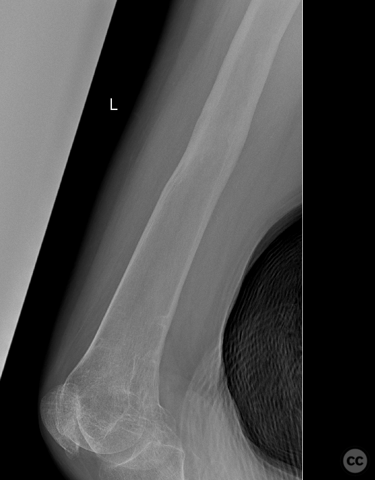 Multifragment intertrochanteric femur fracture with subtrochanteric ...