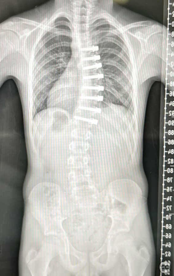 Vertebral Body Tethering for Scoliosis