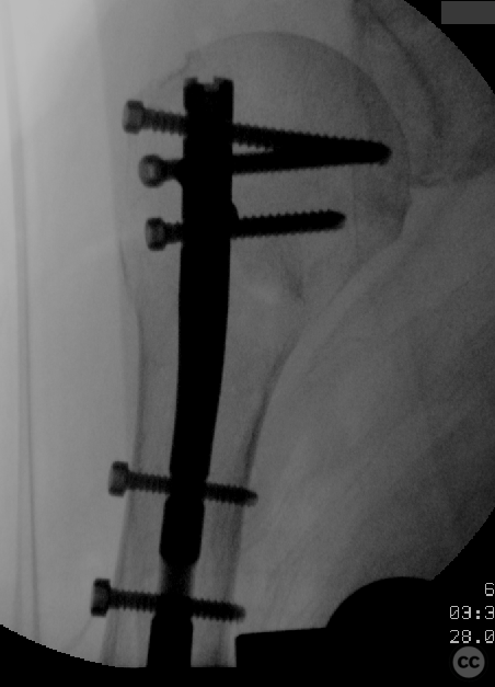 Displaced surgical neck of humerus fracture with brachial plexus ...