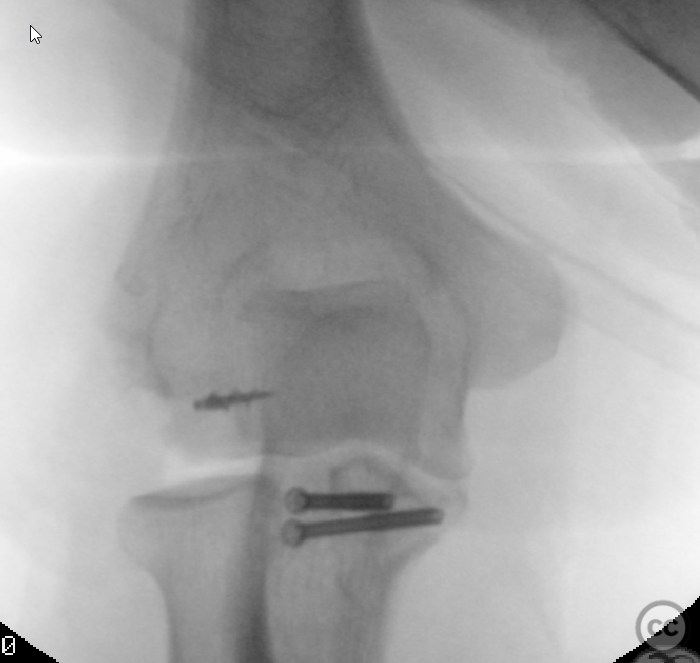 O'Driscoll type 3 coronoid fracture dislocation