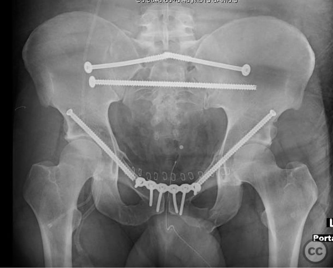 Complex Bilateral Pelvic Ring Injury with APC2 and APC3 Patterns