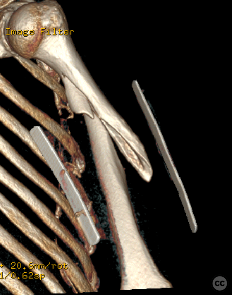 Comminuted spiral midshaft humerus fracture - cerclage and nail