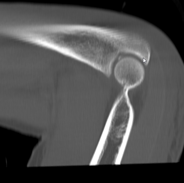 Multidirectional instability following posteromedial elbow dislocation