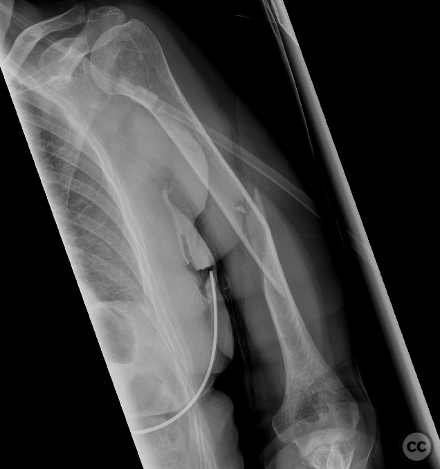 Aggregate lateral approach to a long segmental spiral humerus fracture