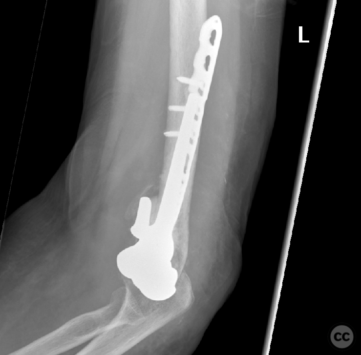 Fracture hemiarthroplasty distal humerus