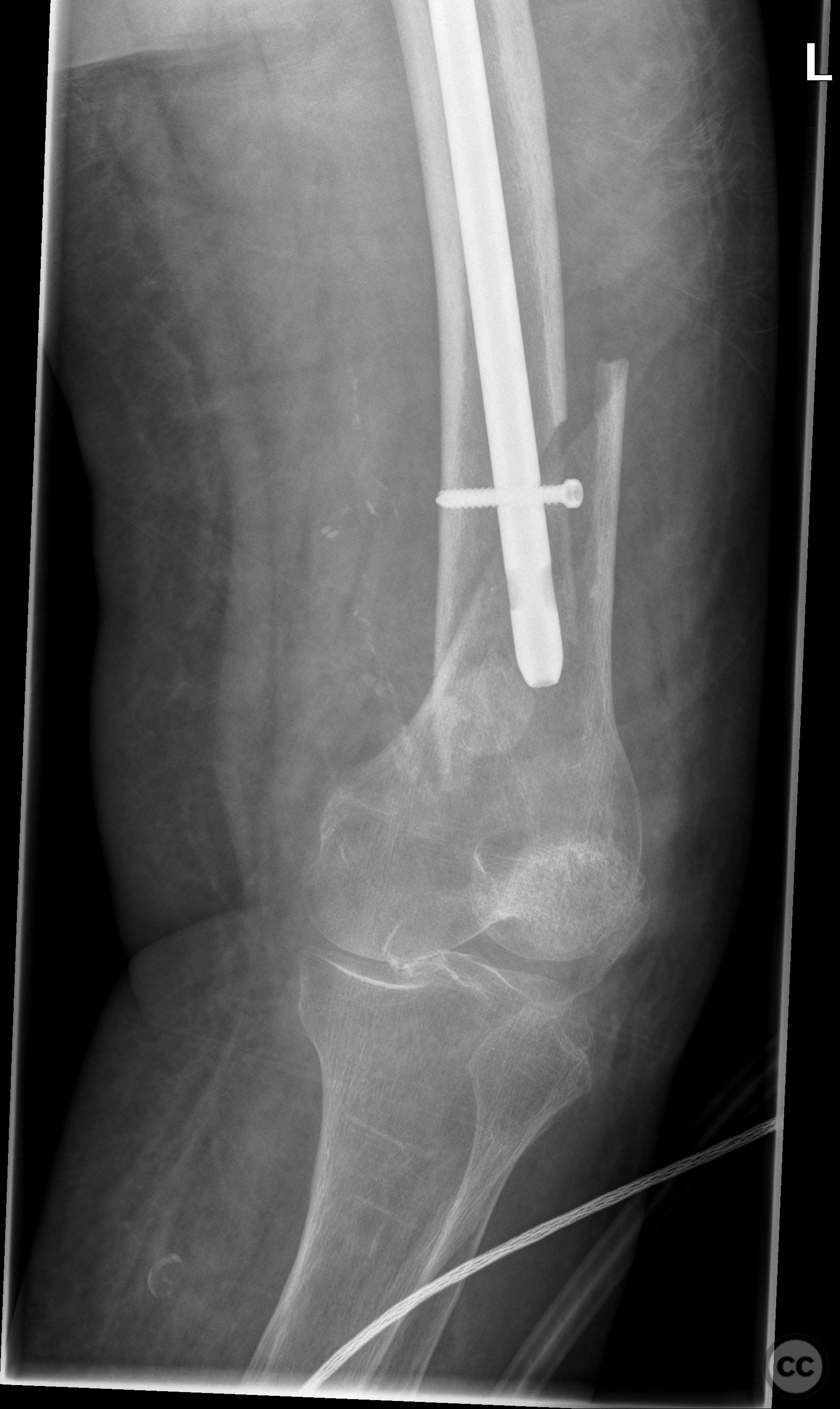 Periosteosynthetic distal femur fracture