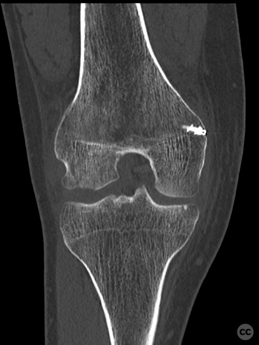 Destructive osteochondral fracture of the lateral femoral condyle ...